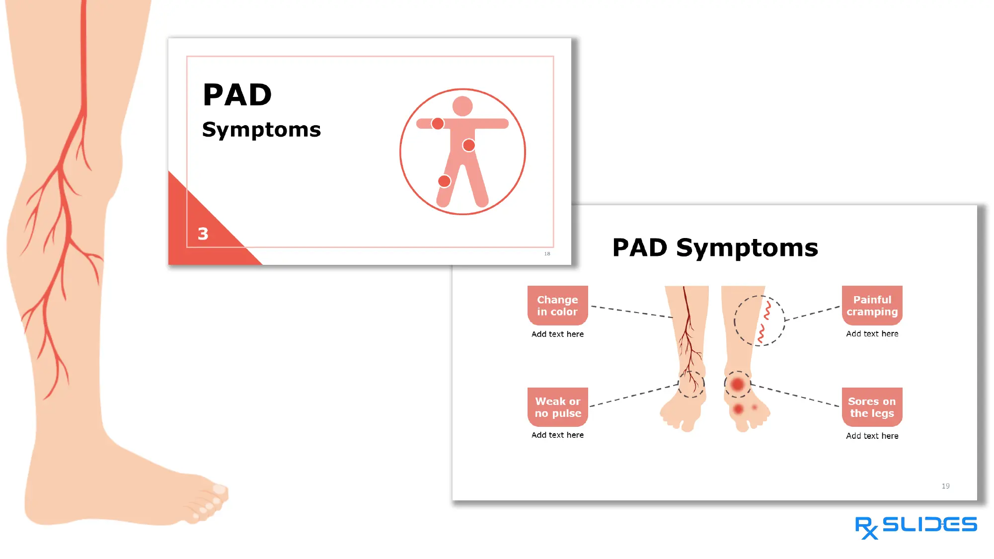 Download Peripheral Arterial Disease PowerPoint Template| RxSlides
